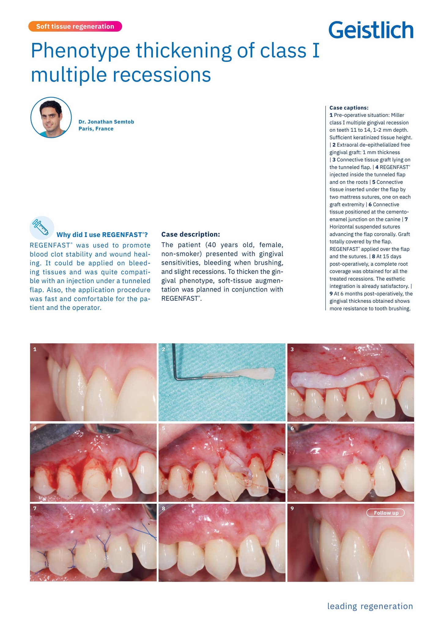 Dr. Jonathan Semtob Paris, France - Phenotype thickening of class I ...