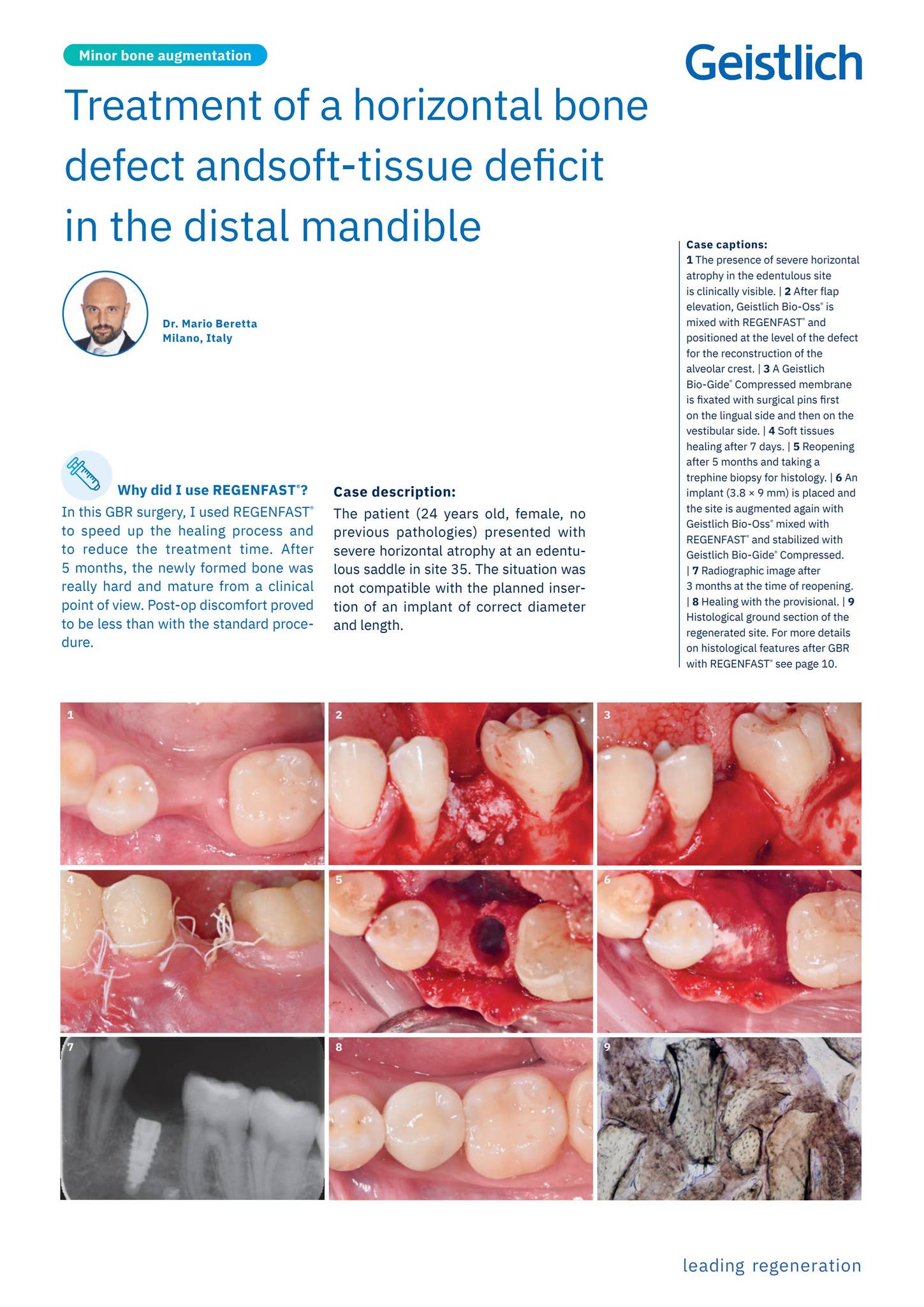 Treatment of a horizontal bone defect andsoft-tissue deficit in the ...