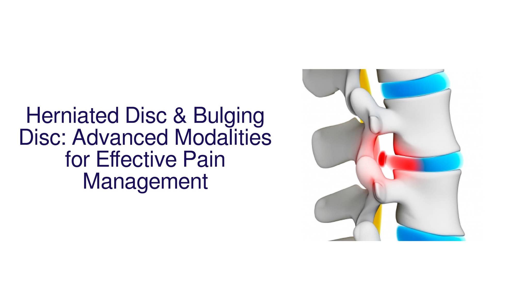 Herniated Disc and Bulging Disc: Advanced Modalities for Effective Pain ...