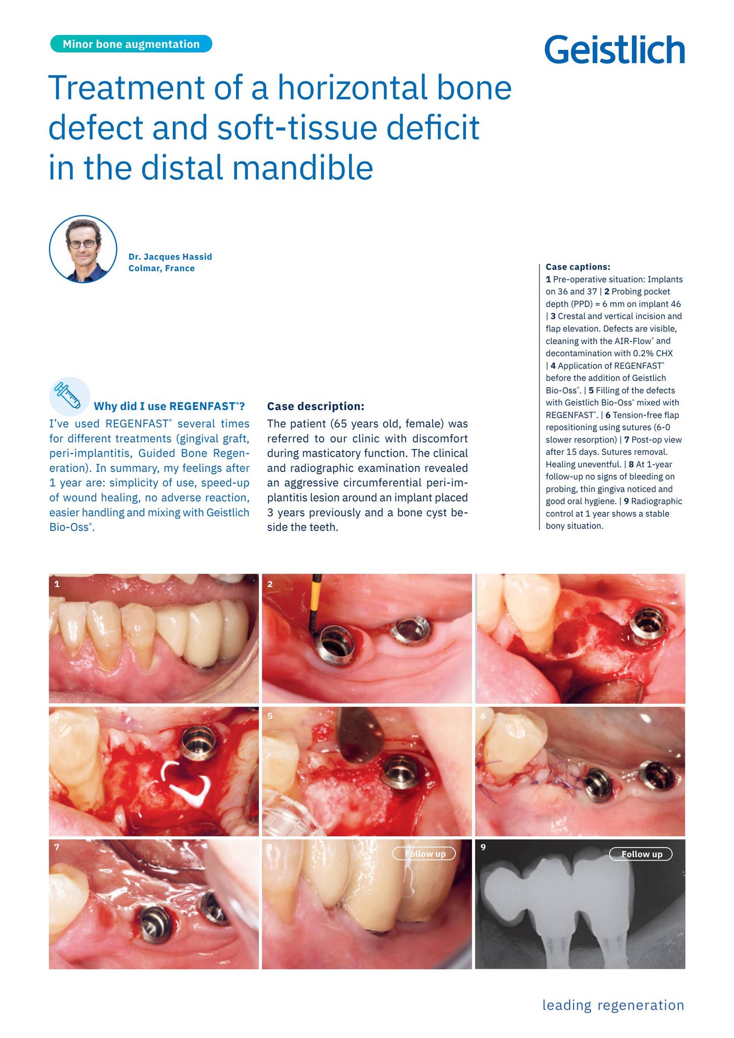 Treatment of a horizontal bone defect and soft-tissue deficit in the ...