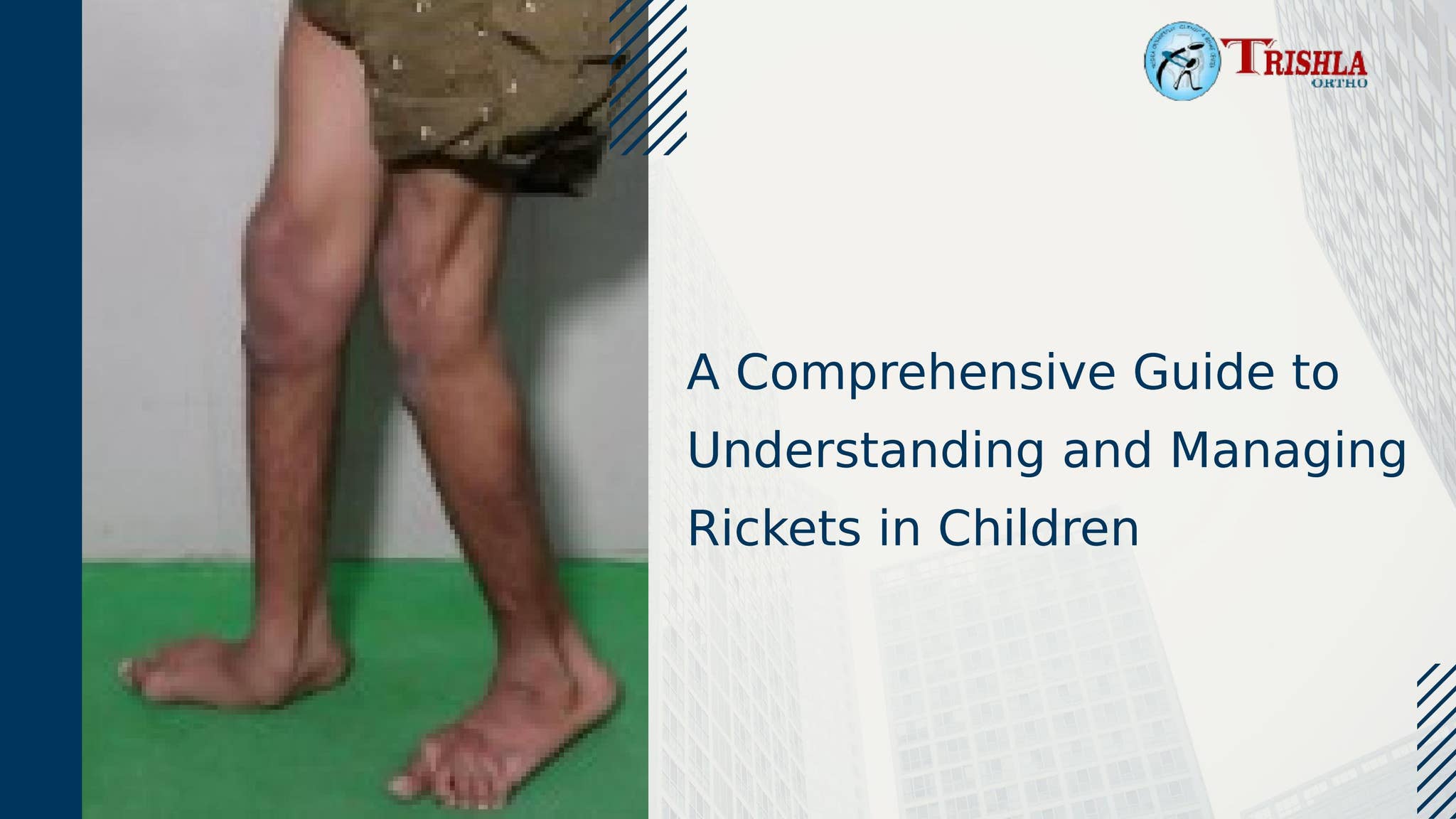 Understanding Rickets in Children: Causes, Symptoms, and Treatment ...