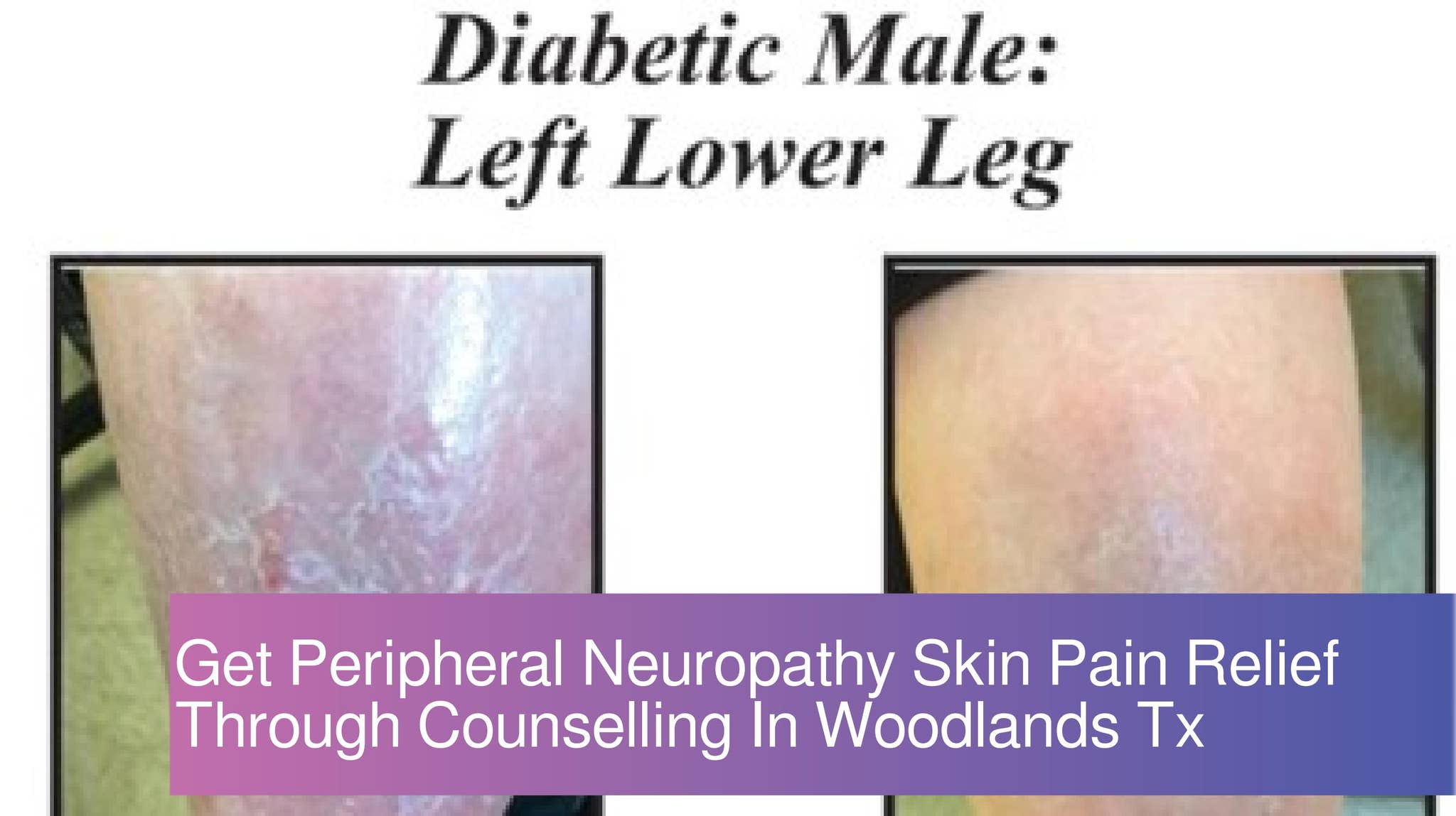 Get Peripheral Neuropathy Skin Pain Relief Through Counselling In ...