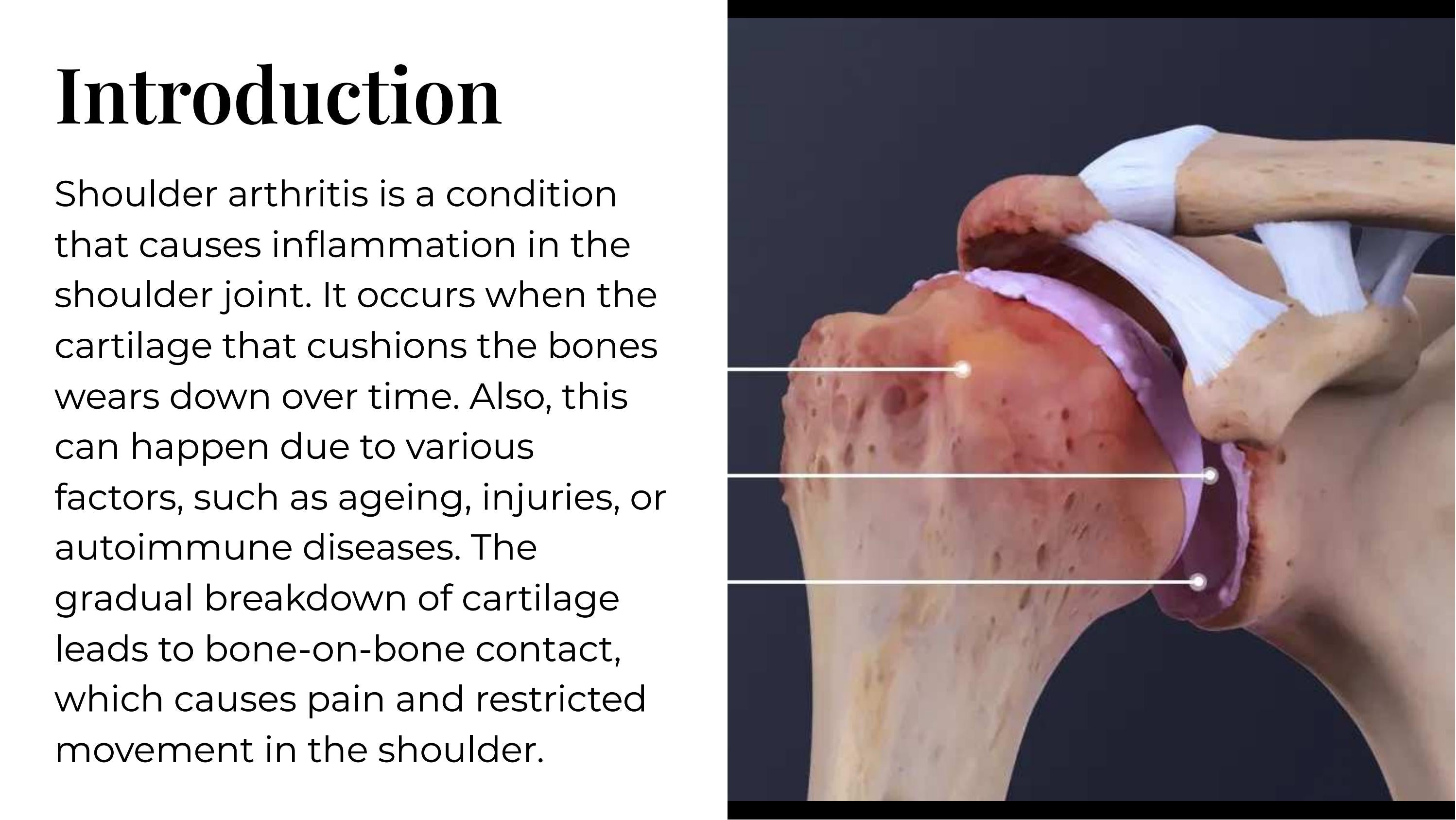 Shoulder Arthritis: Causes, Symptoms and Diagnosis. by Saqsham Ortho ...
