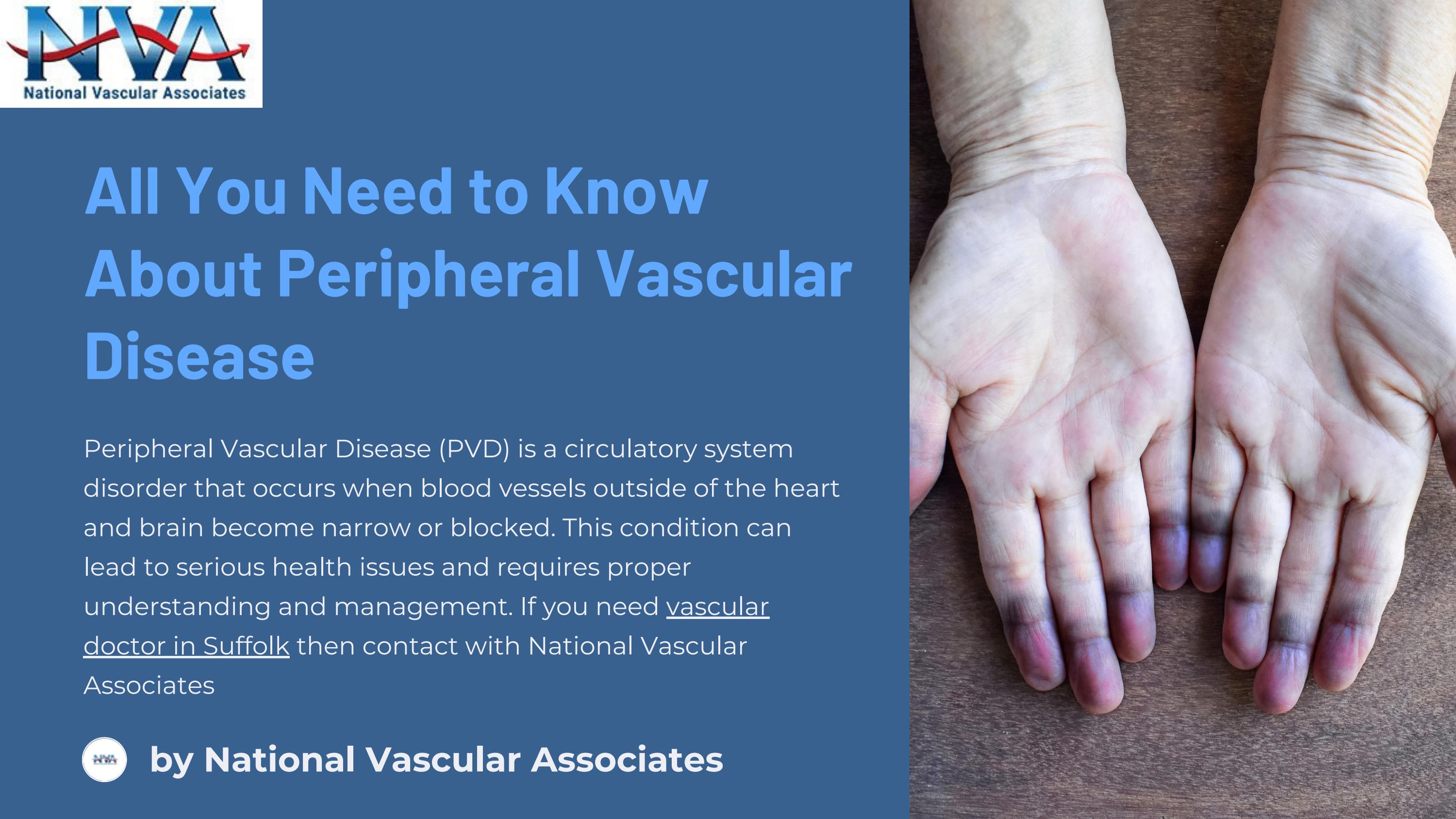 All You Need to Know About Peripheral Vascular Disease by National ...