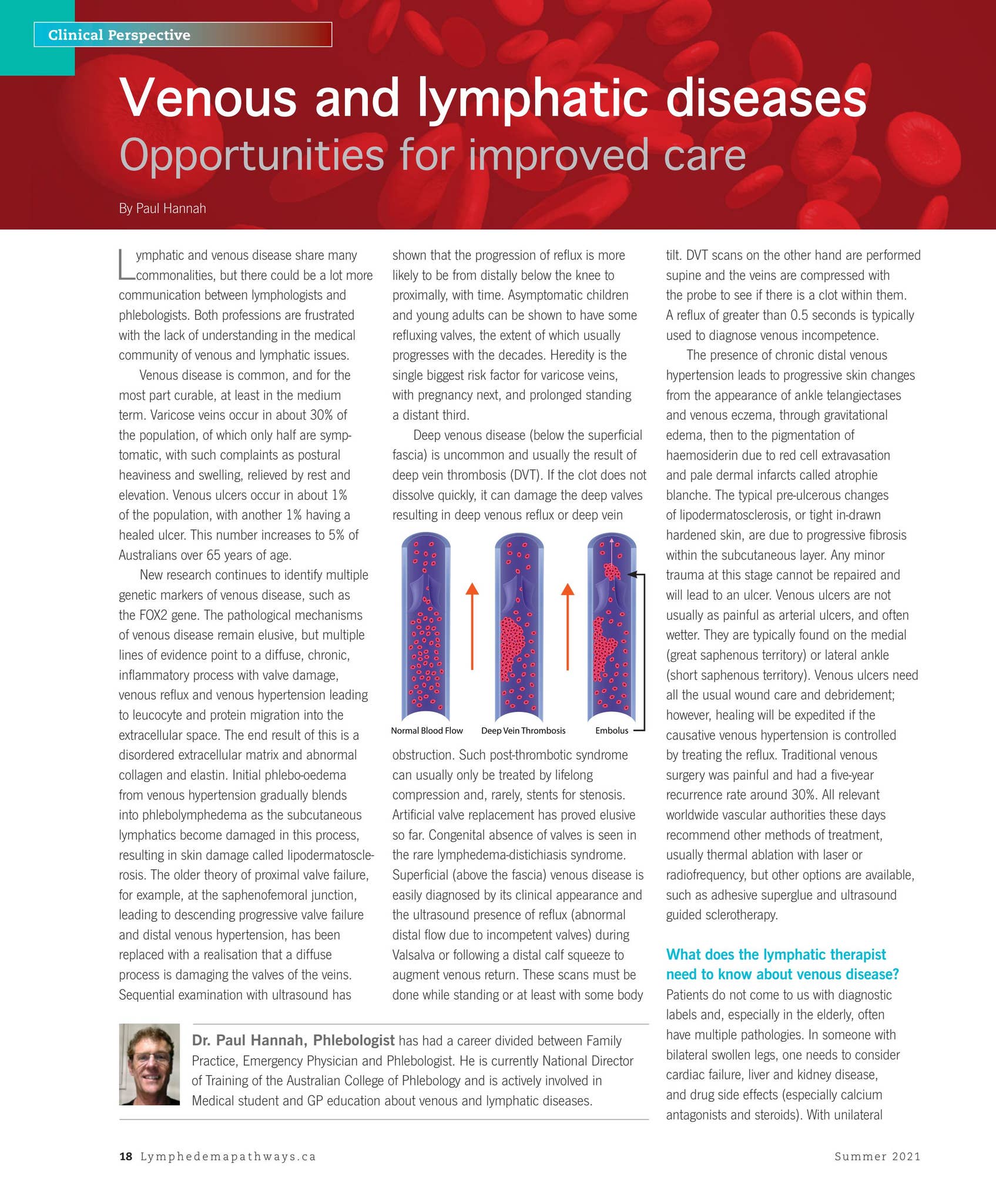 Venous and lymphatic diseases: Opportunities for improved care by Canadian Lymphedema Framework ...
