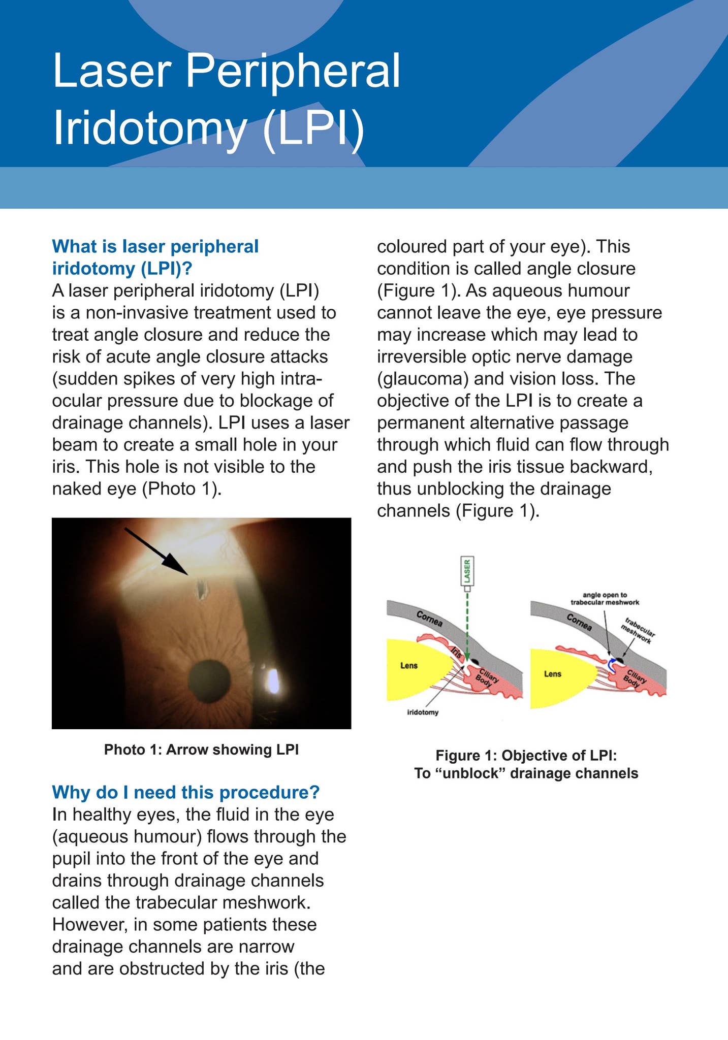 Laser Peripheral Iridotomy (LPI) by Yishun Health - Issuu