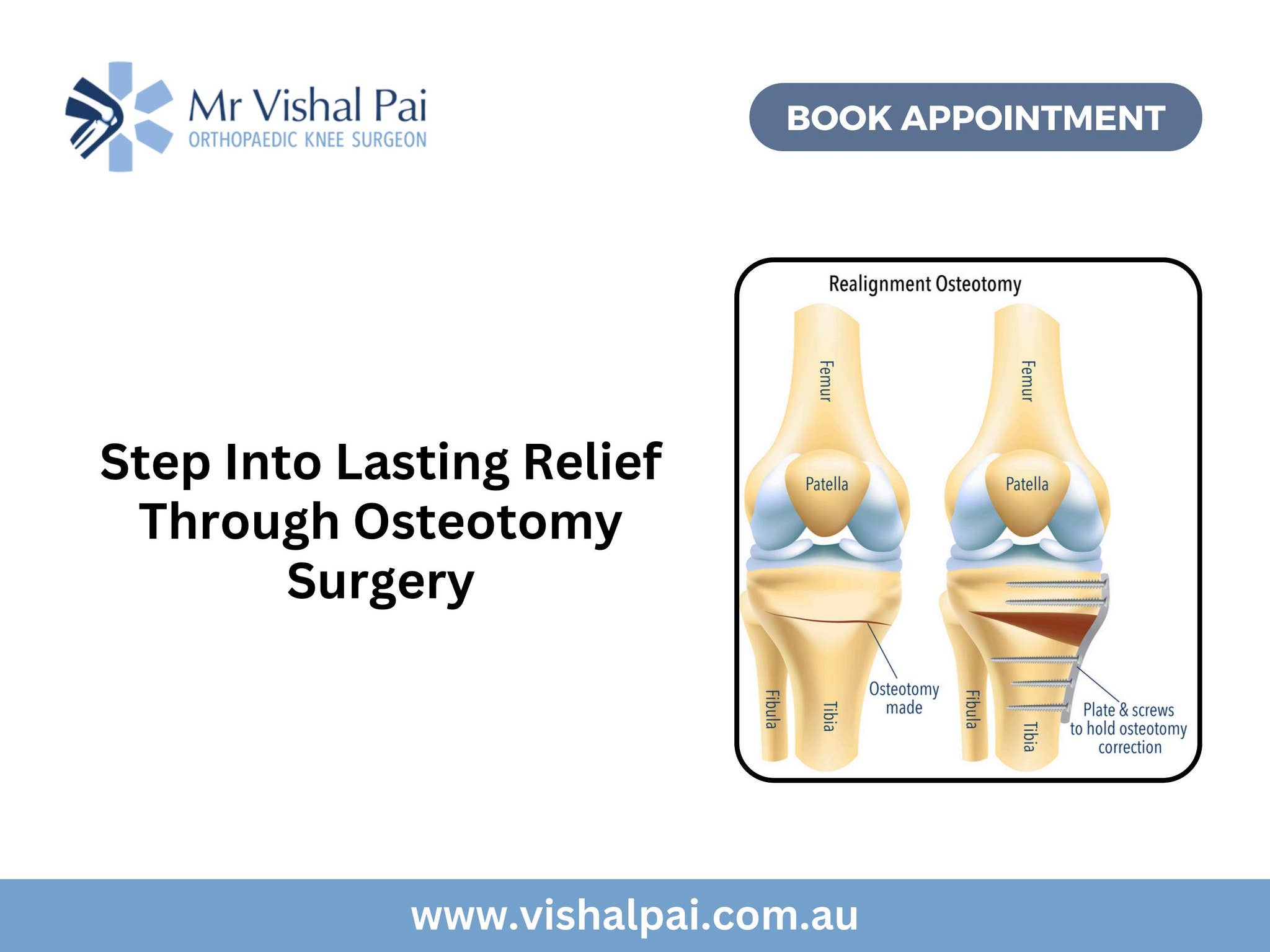 Step Into Lasting Relief Through Osteotomy Surgery by Mr Vishal Pai - Issuu
